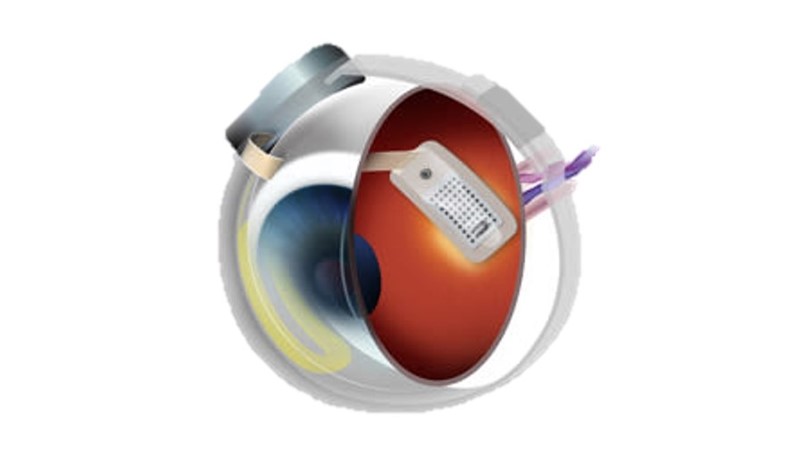 bionic-vision.org | Implants | Argus II