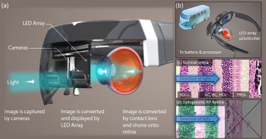 bionic-vision.org | Implants | Newcastle Visual Prosthesis