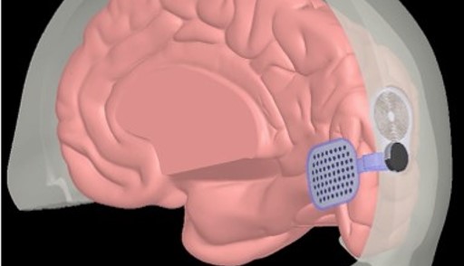 bionic-vision.org | Implants | Orion Cortical Visual Prosthesis System